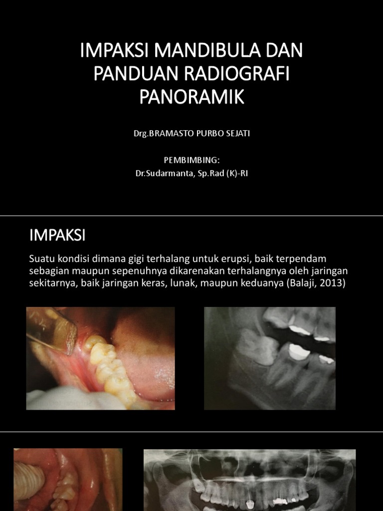 Impaksi PDF | PDF