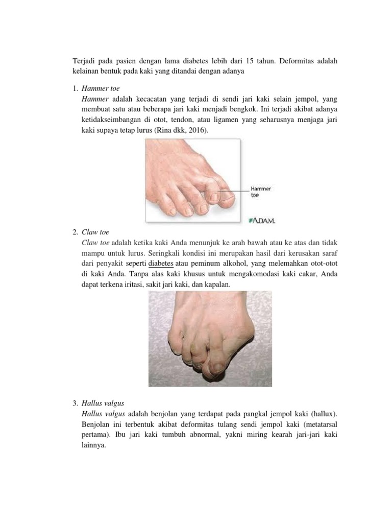 Bentuk Kaki DM | PDF