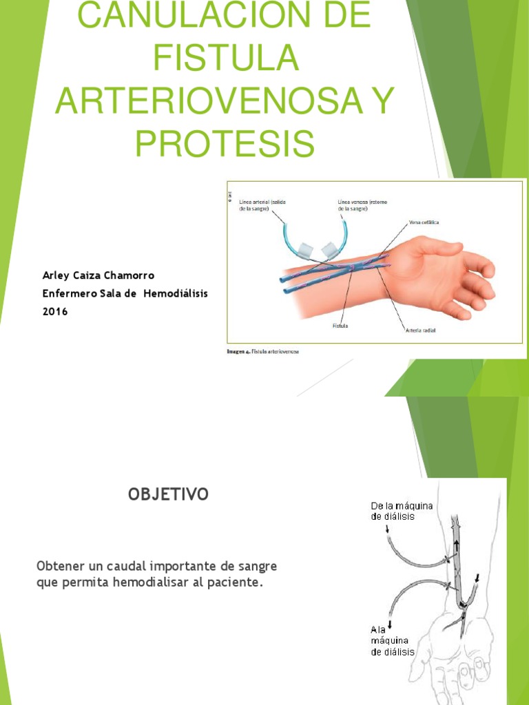 Canulacion Fistula | PDF | Hemodiálisis | Medicina