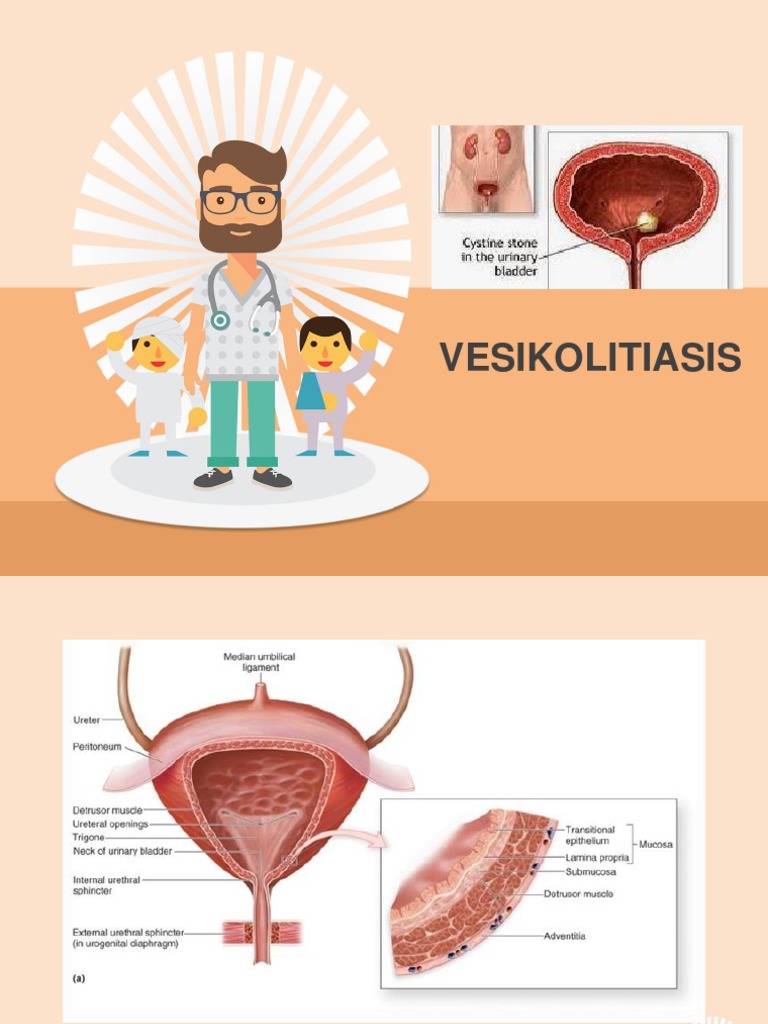 VESICOLITHIASIS | Urinary Bladder | Surgical Specialties