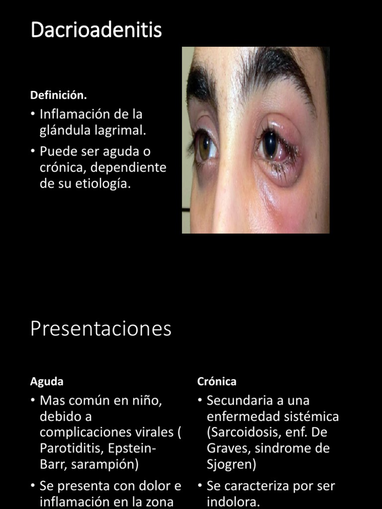 Dacrioadenitis | PDF