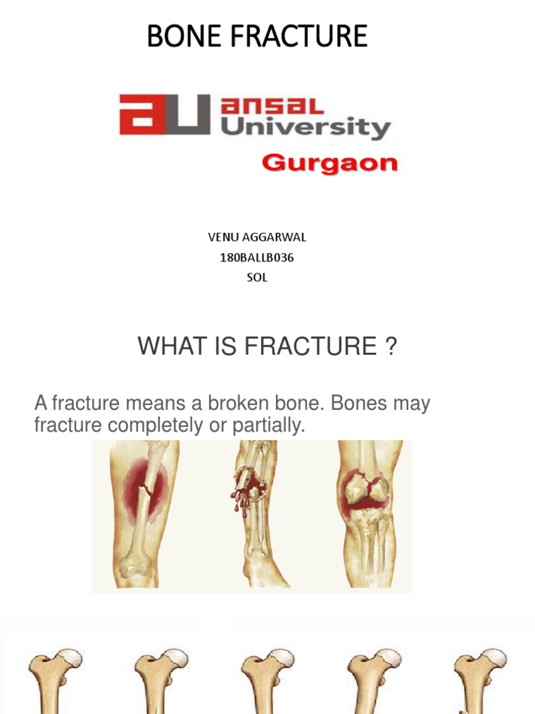Bone Fracture: Venu Aggarwal 180BALLB036 SOL | PDF | Sports ...