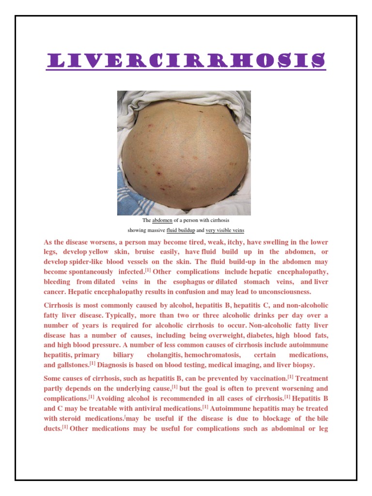 Livercirrhosis: The Abdomen of A Person With Cirrhosis Showing Massive ...