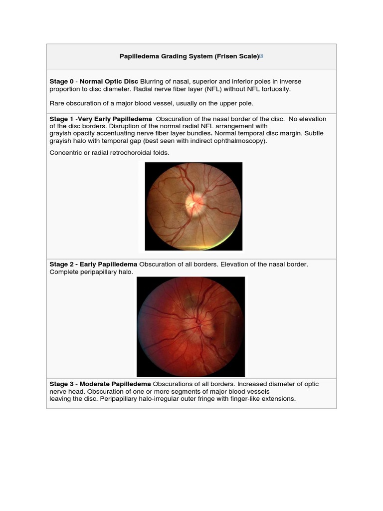 Papilledema Grading System (Frisen Scale) | PDF