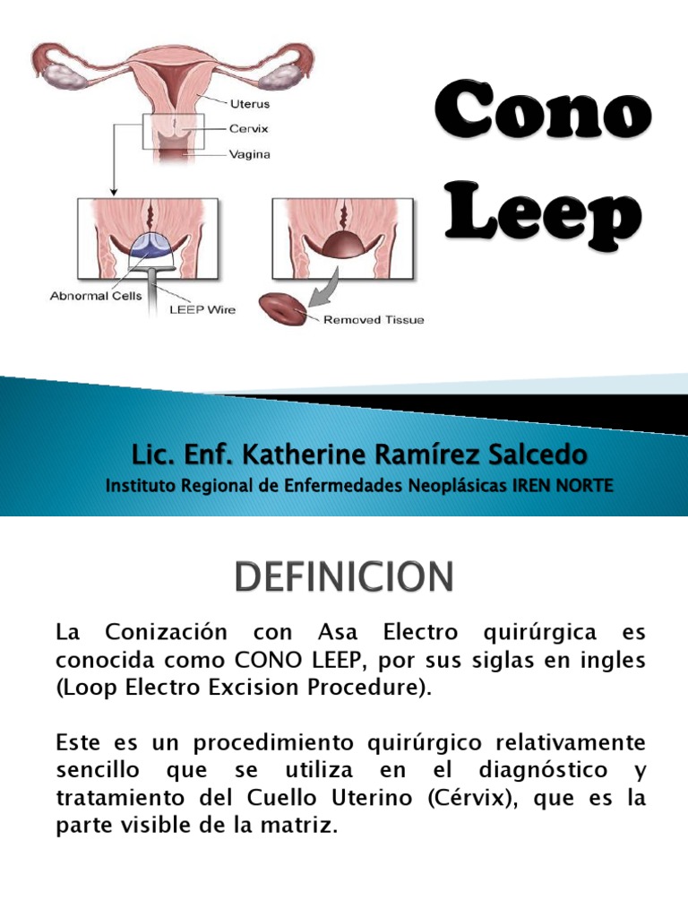 Cono Leep 2 | PDF | Vagina | Especialidades Medicas