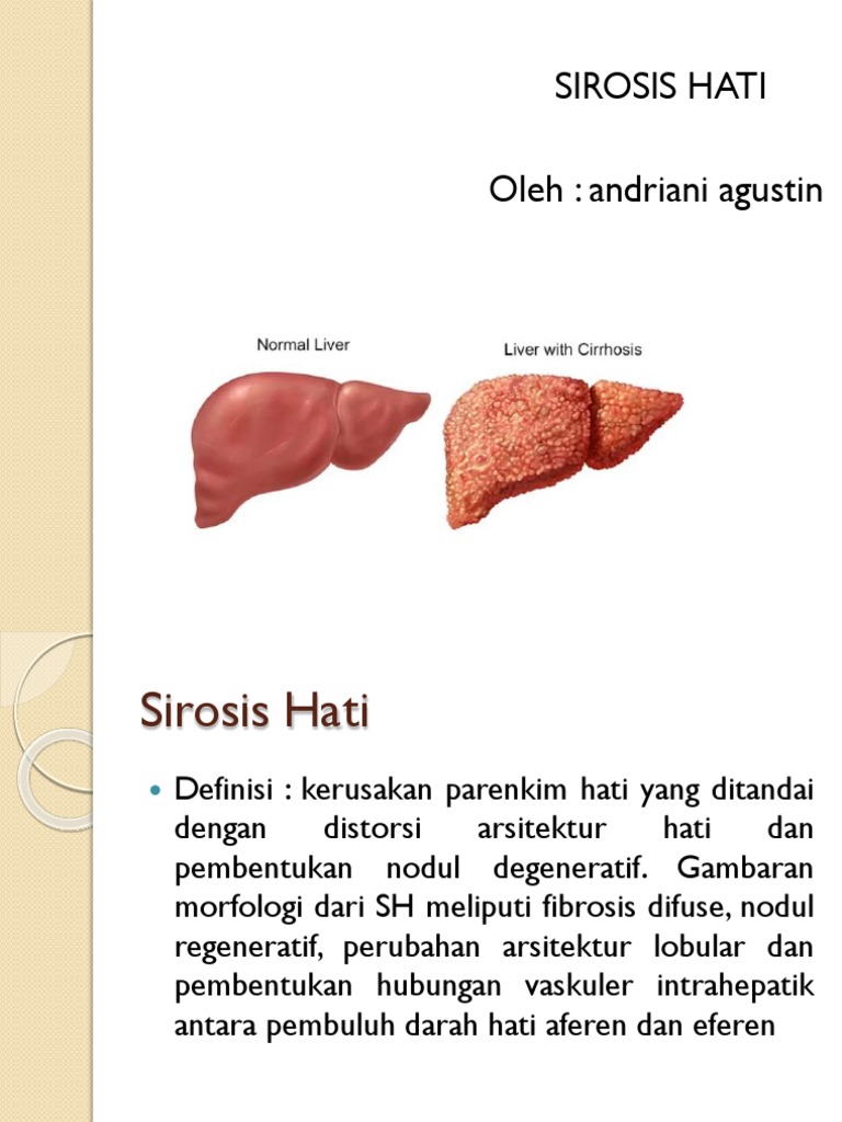 Sirosis Hati | PDF | Sains & Matematika