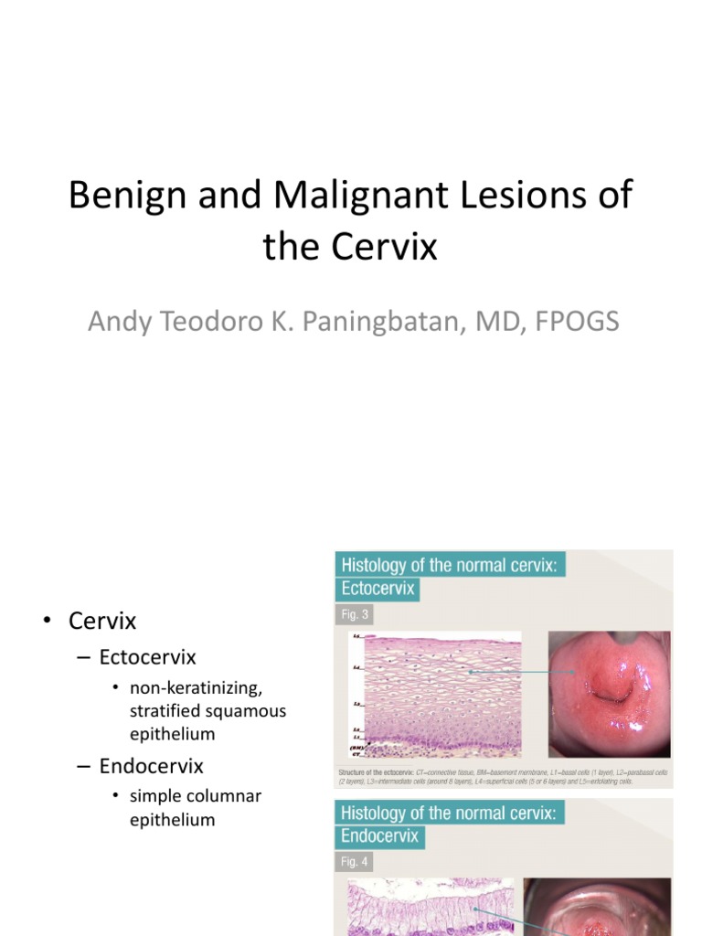 1 Benign and Malignant Lesions of The Cervix | PDF | Cervical Cancer ...