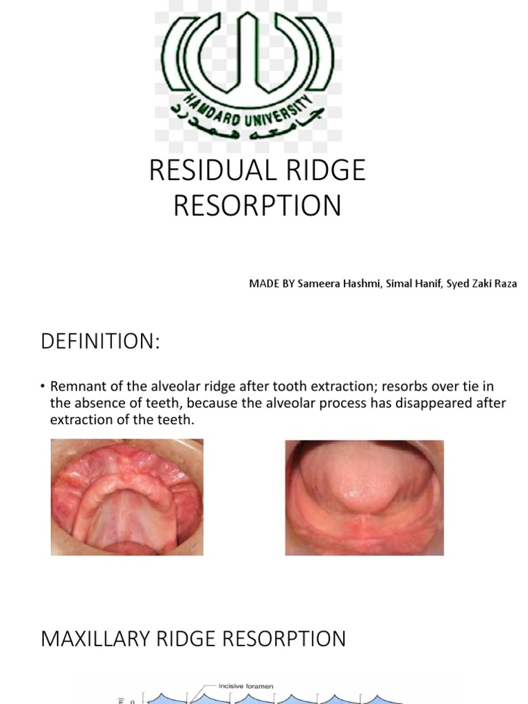 Residual Ridge Resorption: MADE BY Sameera Hashmi, Simal Hanif, Syed ...
