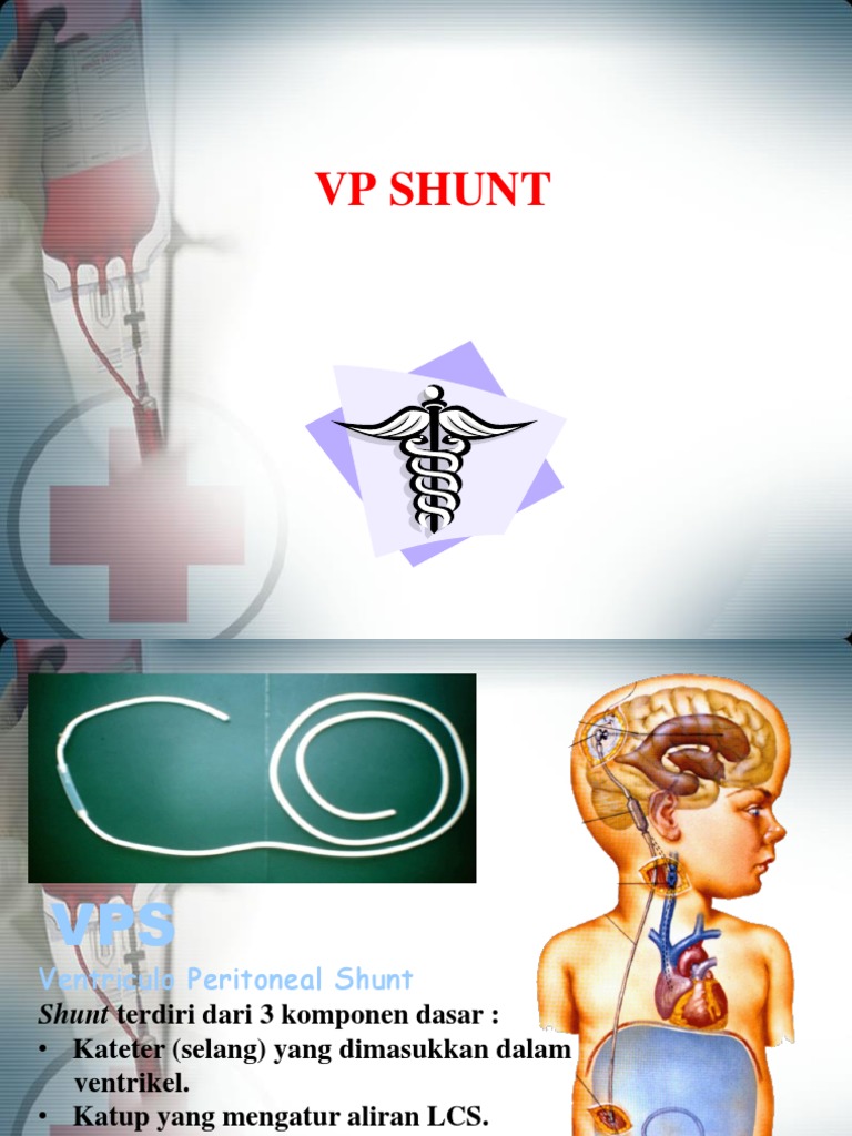 VP Shunt | PDF | Ilmu Sosial | Sains & Matematika