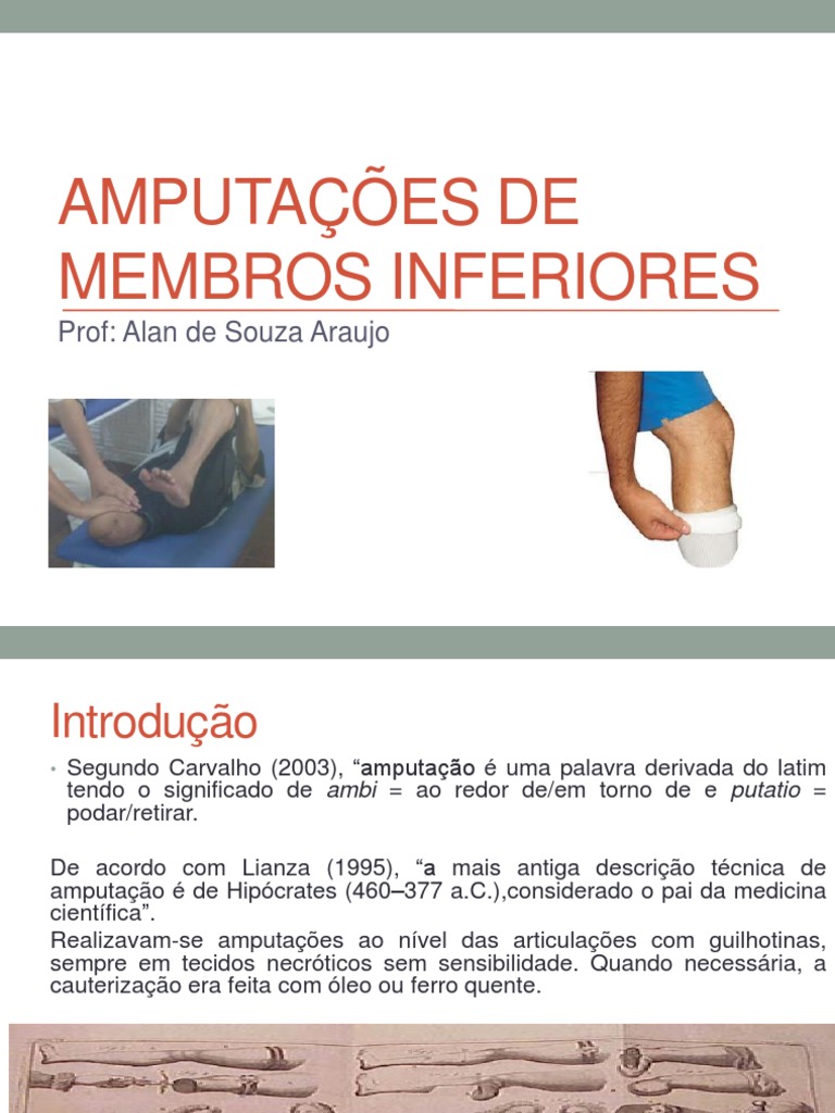 AMPUTAÇÕES DE MEMBROS INFERIORES: DEFINIÇÃO, ETAPAS CIRÚRGICAS, NÍVEIS ...