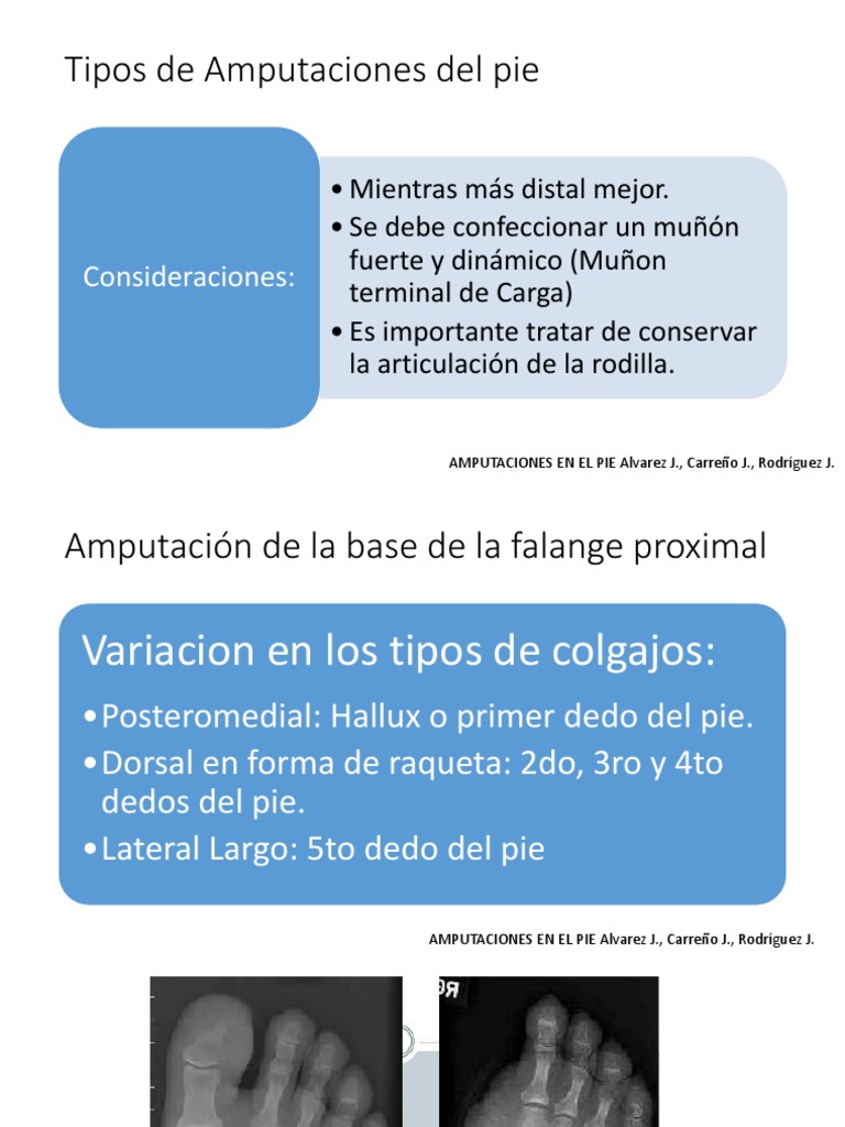 Tipos de Amputaciones del pie: Consideraciones | Pie | Tobillo
