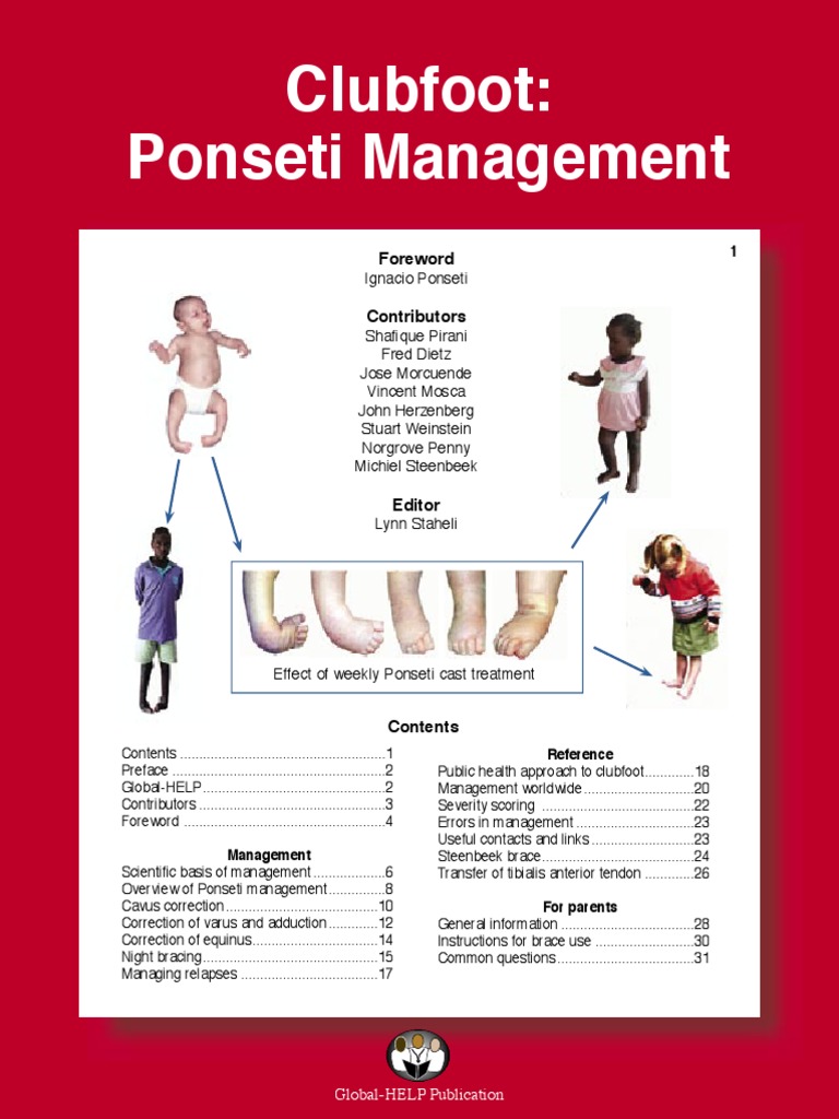 Ponsetti Method | Download Free PDF | Foot | Lower Limb Anatomy
