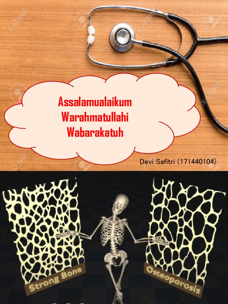 Presentation Osteoporosis Devi Safitri | PDF | Science & Mathematics