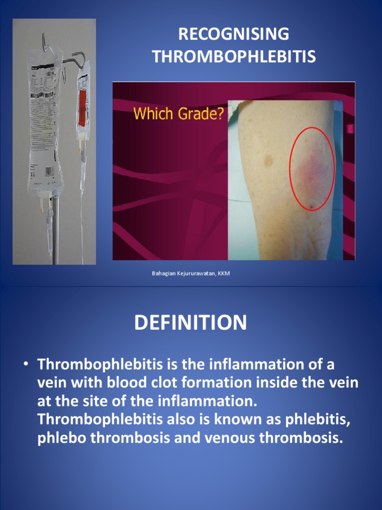 1. Teaching Slide Recognising Thrombophlebitis | Intravenous Therapy ...