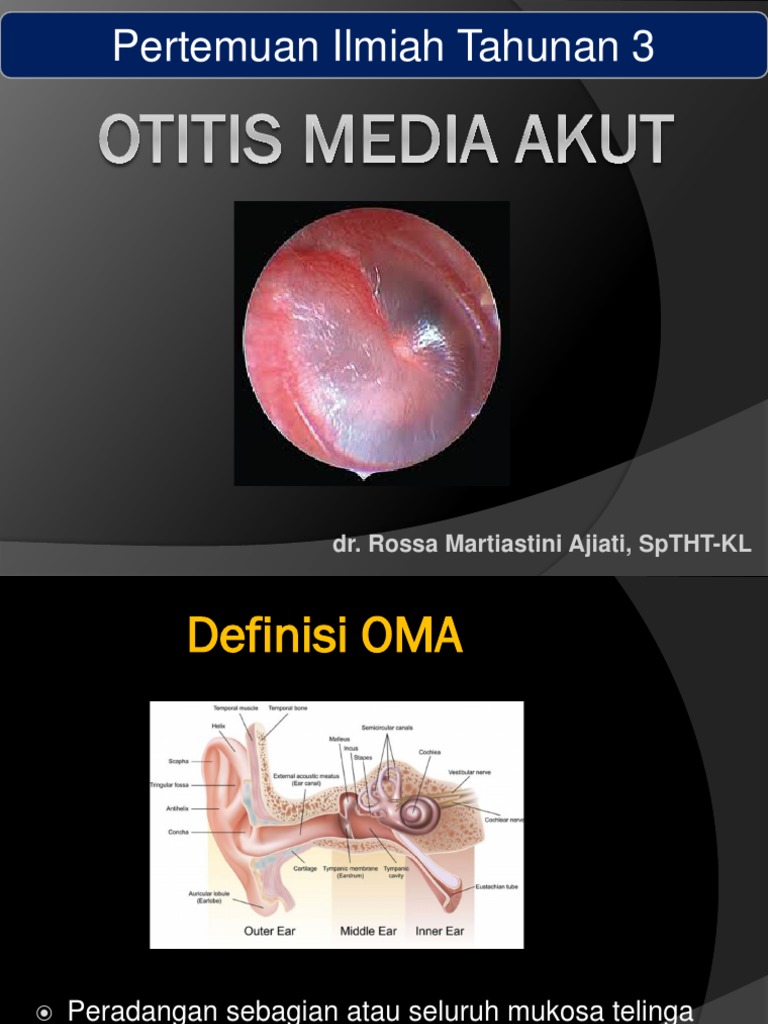 Otitis Media Akut | PDF