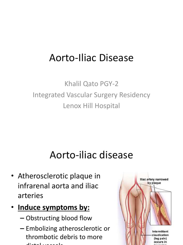 Aorto-Iliac Disease Overview | PDF | Aorta | Atherosclerosis