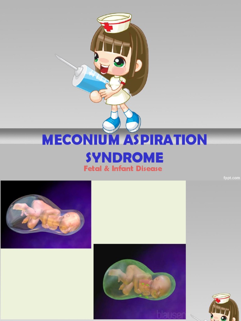 Miconium Aspiration Syndrome | PDF | Fetus | Breastfeeding