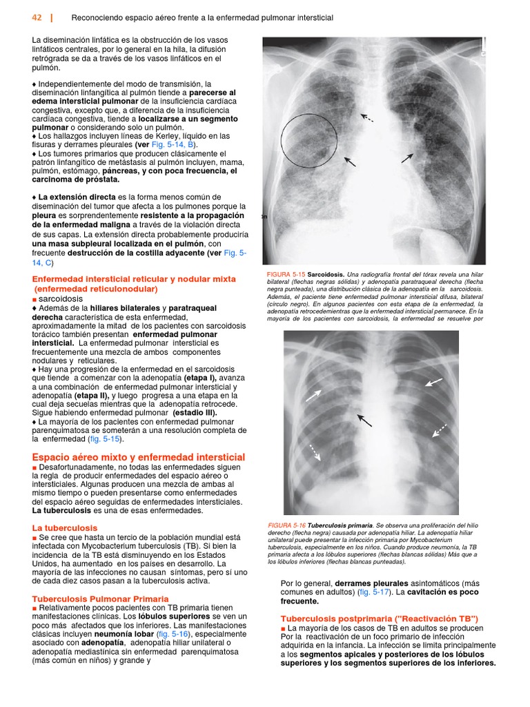 Radiografia de Torax | PDF | Tuberculosis | Pulmón