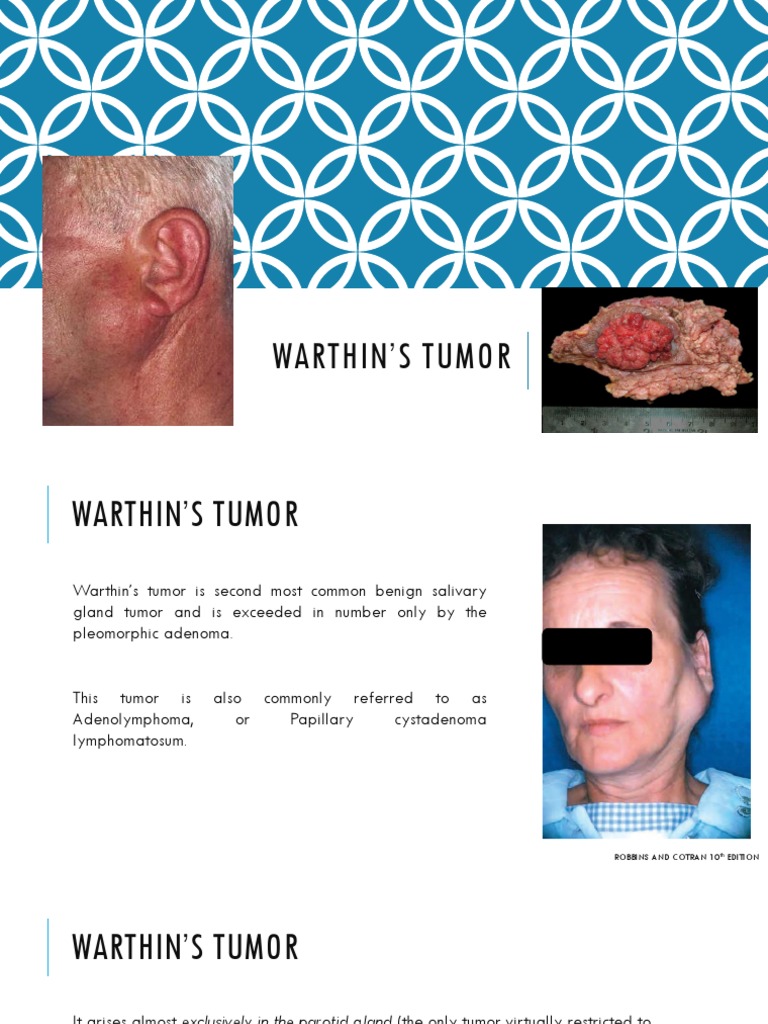 Warthin's Tumor | PDF | Neoplasms | Epithelium