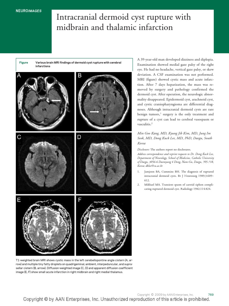 Intracranial Dermoid Cyst Rupture With Midbrain and Thalamic Infarction ...
