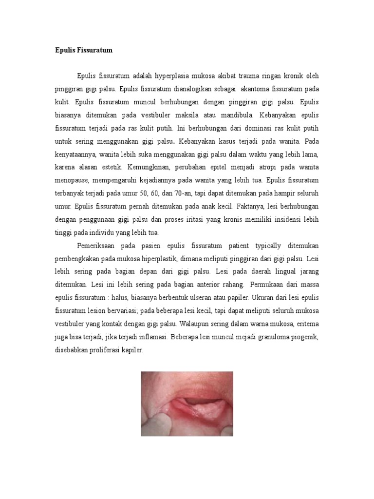 Epulis Fissuratum | PDF