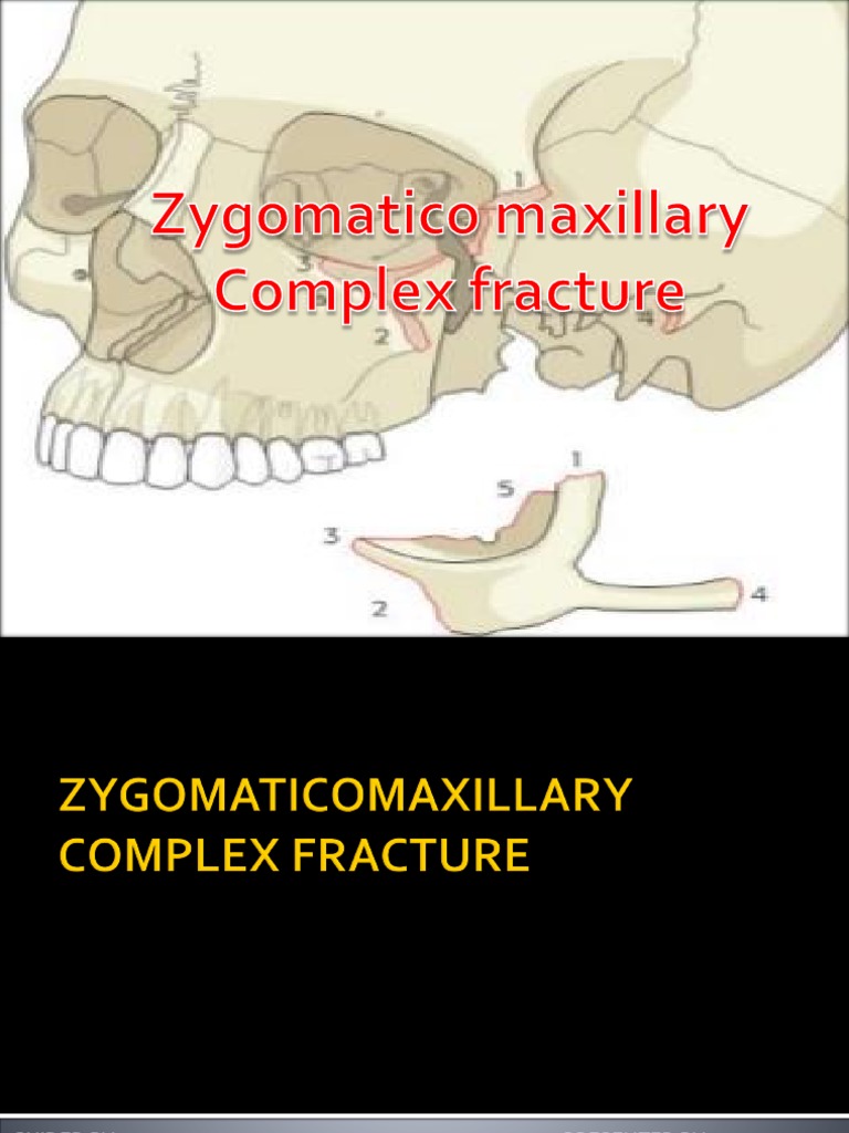 ZMC Fracture in Oral Surgery | PDF | Human Anatomy | Medical Specialties