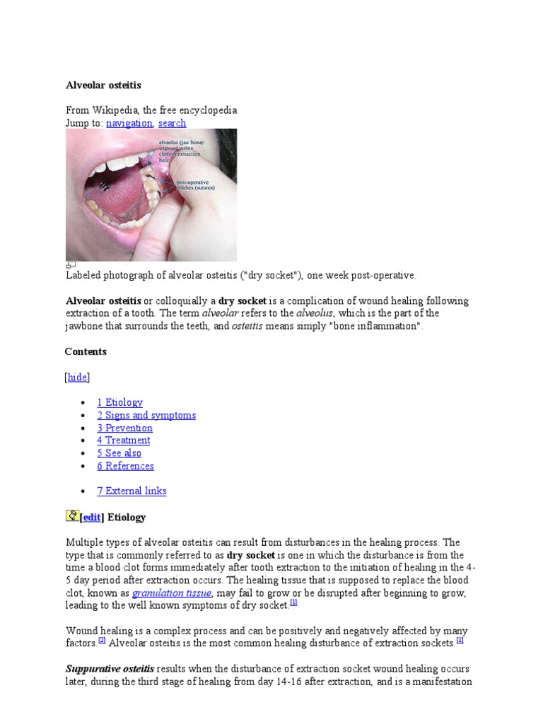 Dry Socket Drg | Dentistry | Diseases And Disorders
