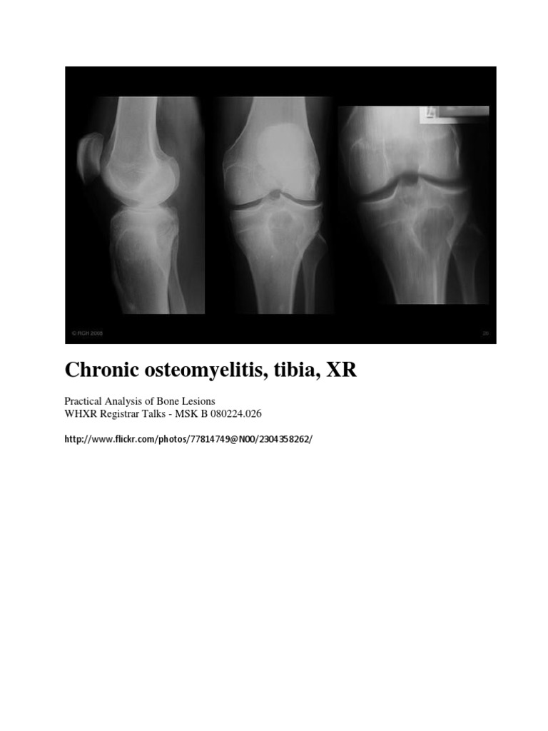 Chronic Osteomyelitis in Tibia XR Analysis | PDF