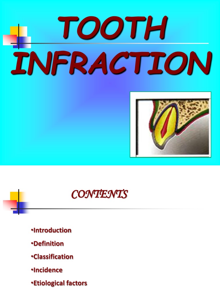 Infraction Tooth | PDF | Dentistry | Dental Anatomy