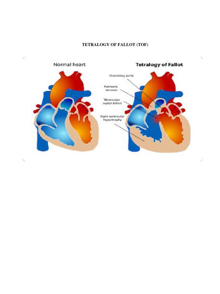 Tetralogy of Fallot (Tof) | PDF