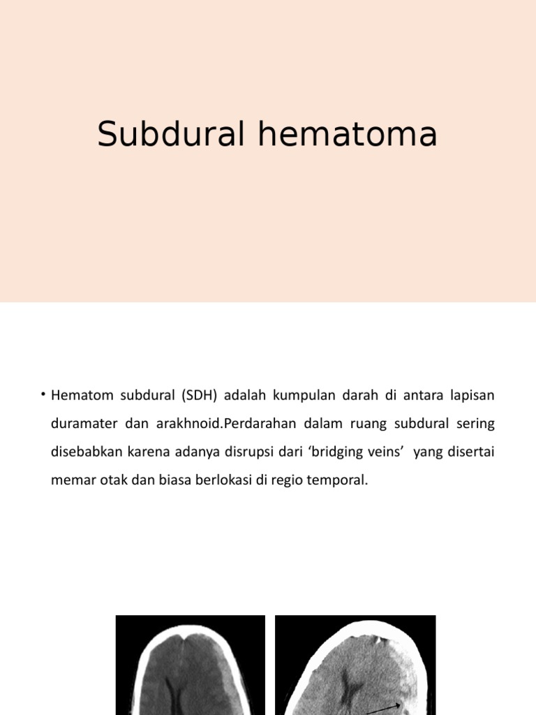 SDH, Edh, Ich, Ivh, Sah | PDF