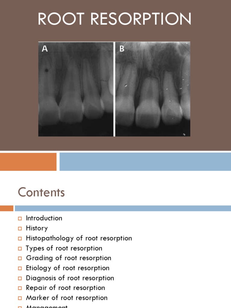 Root Resorption | PDF | Human Tooth | Mouth