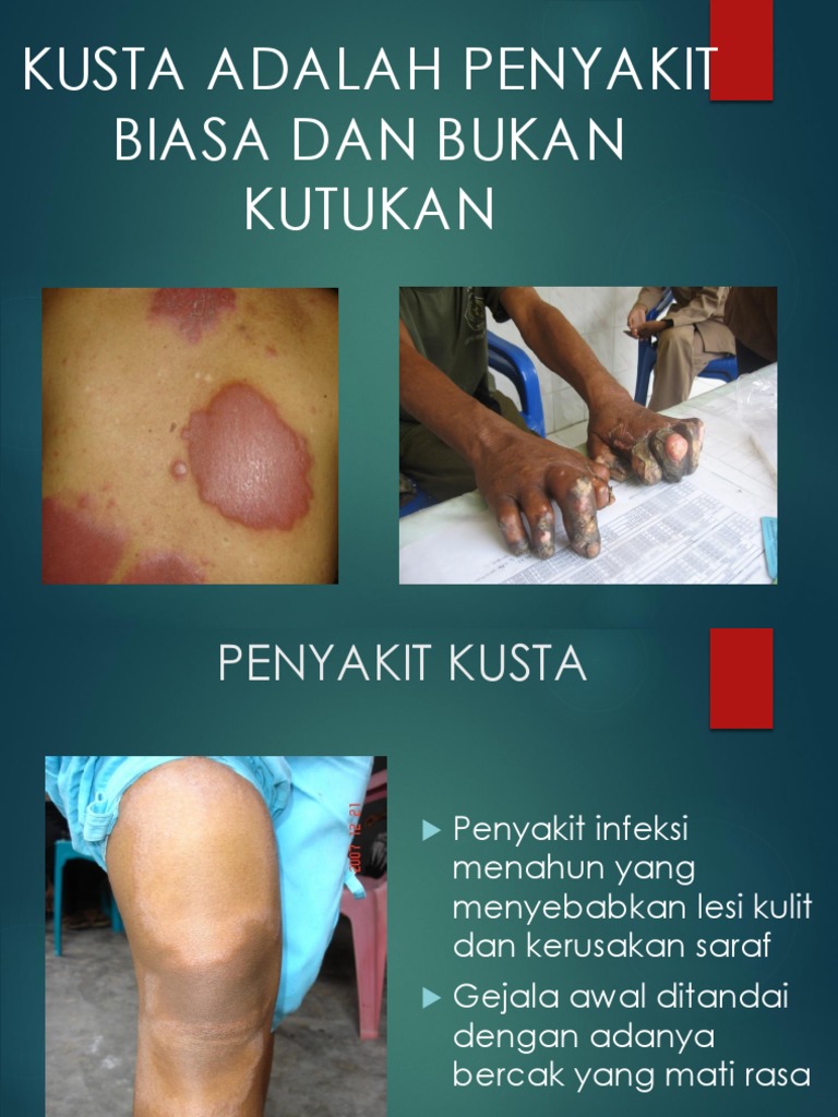 Penyuluhan Kusta (Dokter) | PDF