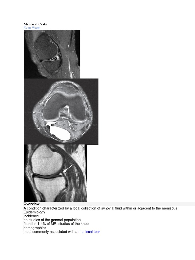 Meniscal Cysts | PDF | Knee | Musculoskeletal System