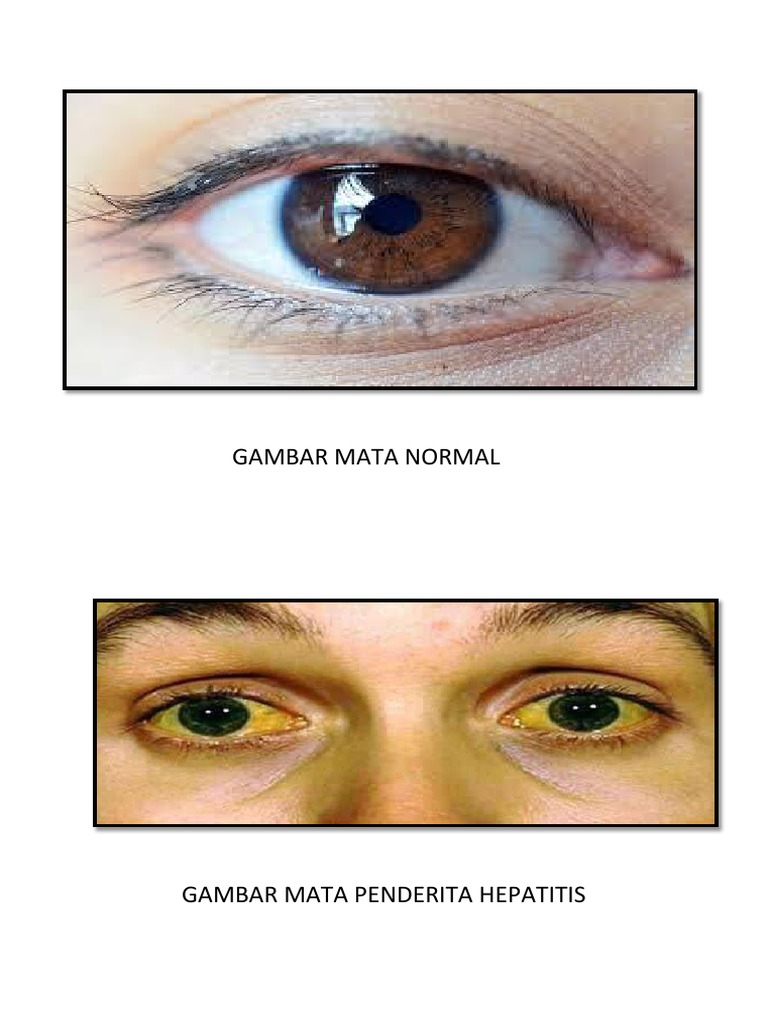 Gambar Mata Normal | PDF