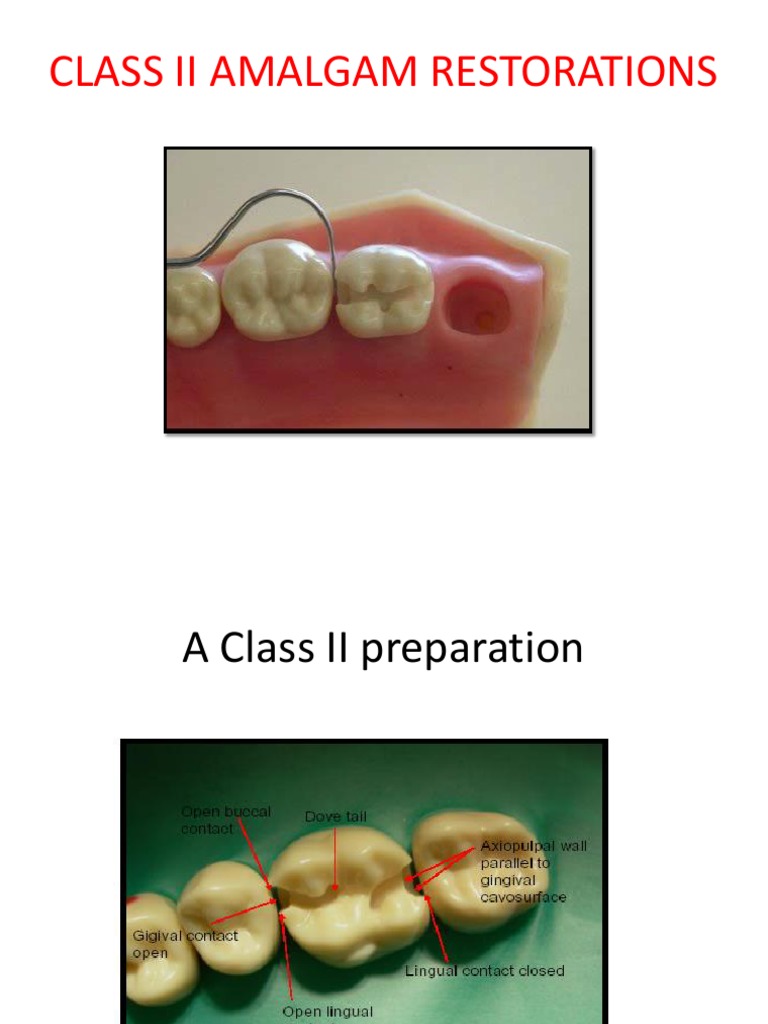 Cde-Class II Amalgam Restorations-31!12!14 | PDF | Tooth Enamel | Mouth