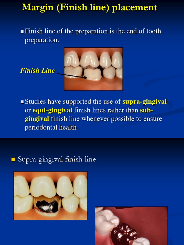 Finish Line of The Preparation Is The End of Tooth Preparation | PDF ...