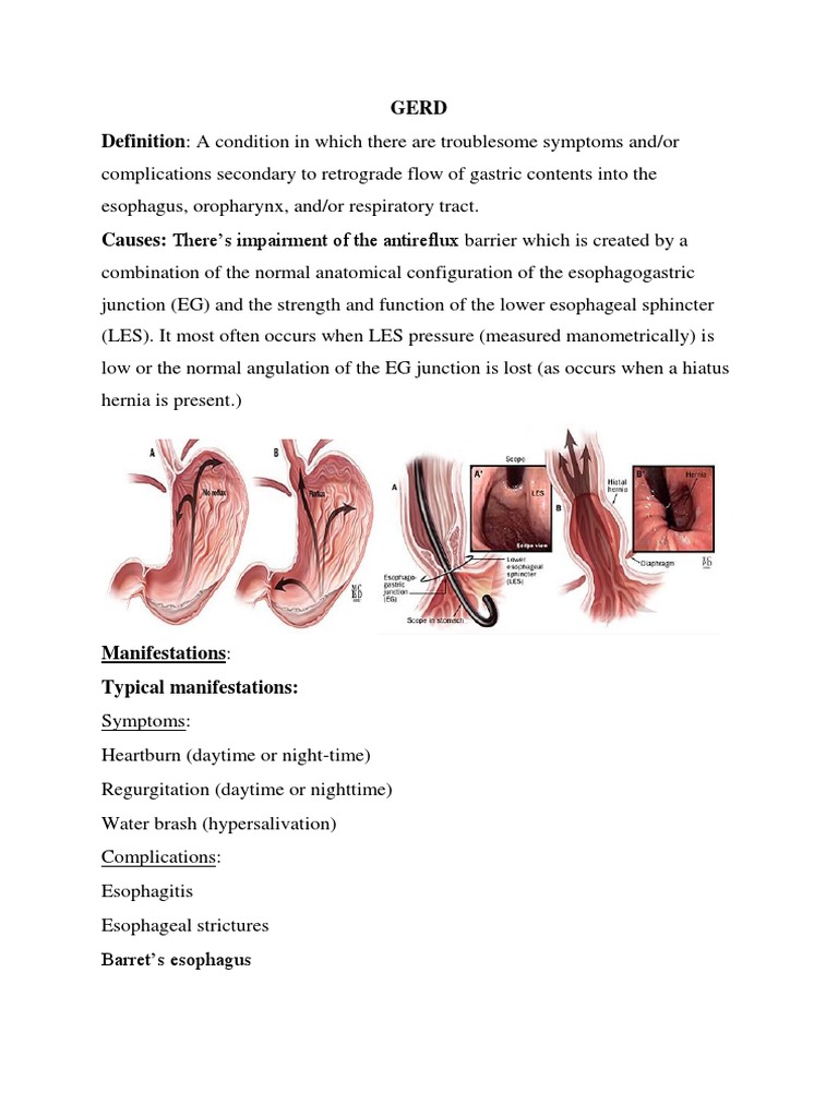 Gerd Definition: A Condition in Which There Are Troublesome Symptoms ...