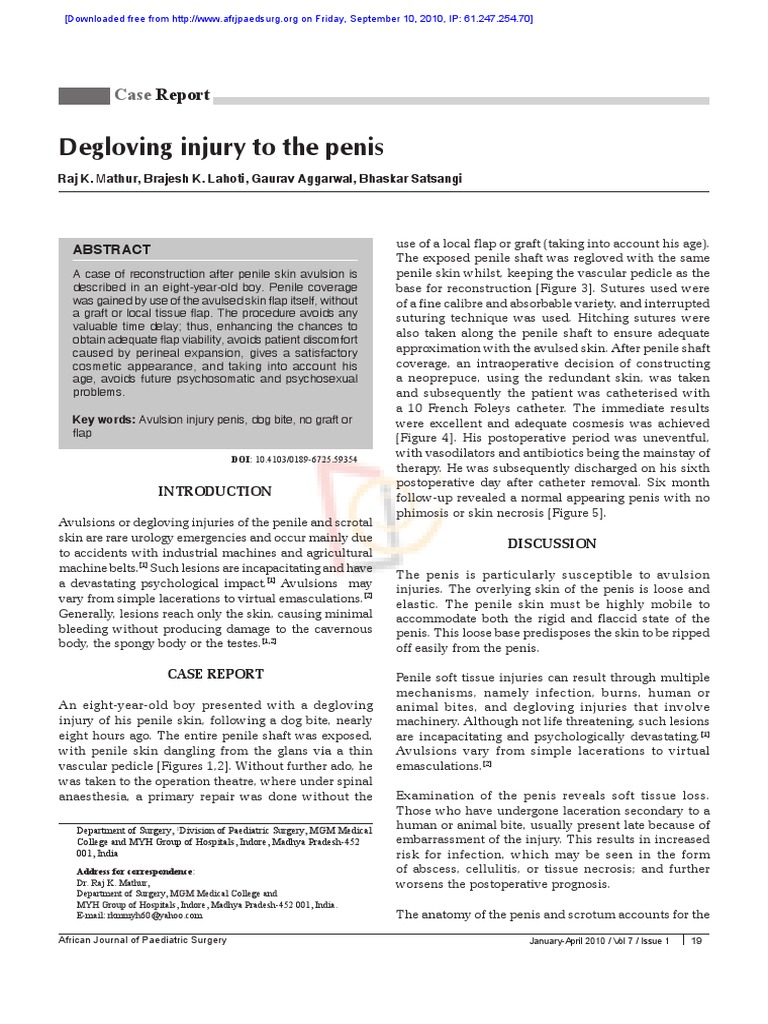 Reconstructing a Penile Degloving Injury in an Eight-Year-Old Boy Through Primary Repair With ...