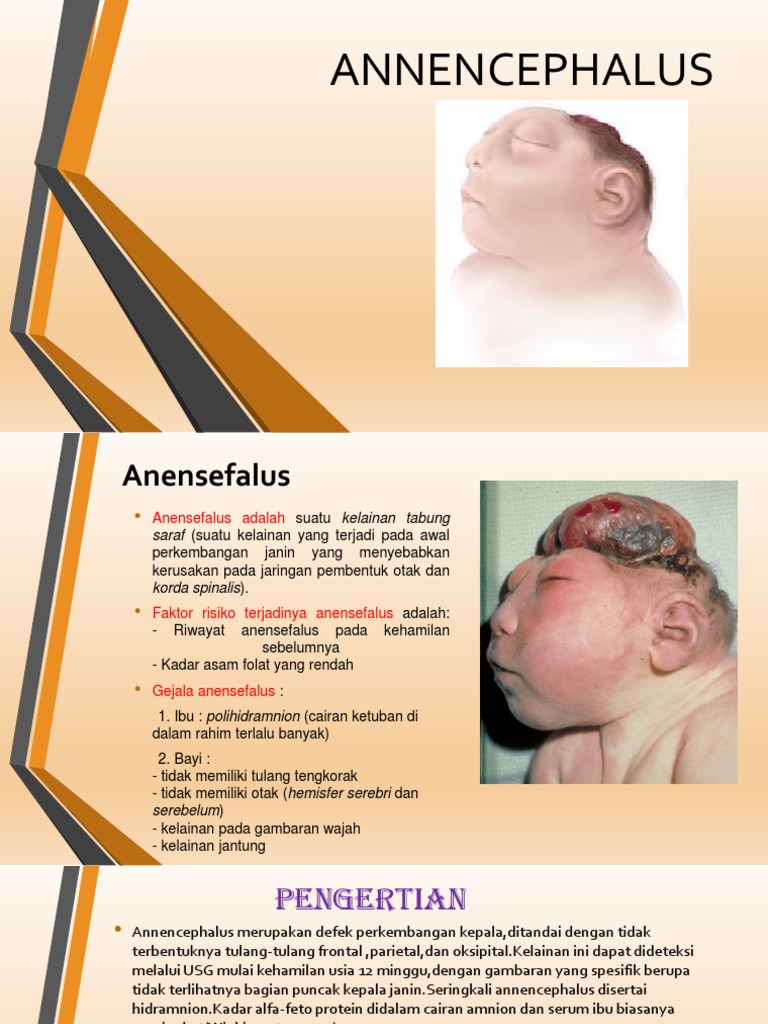 Malformasi Anensefalus | PDF
