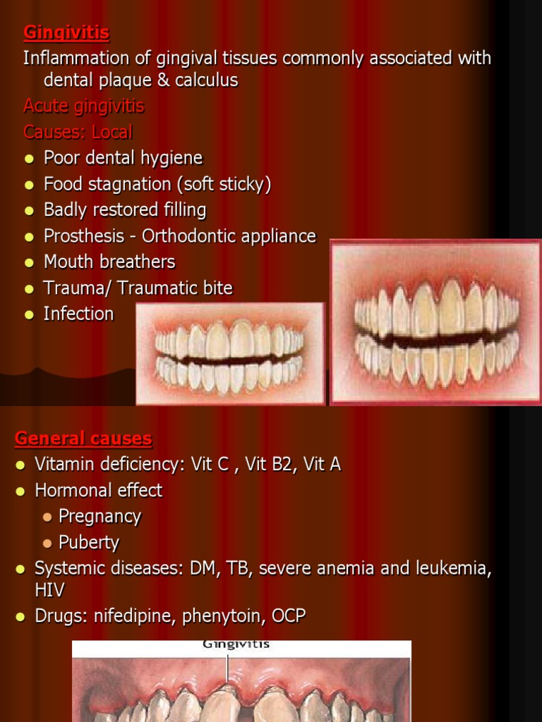 An In-Depth Review of Gingivitis: Causes, Types, Clinical Features, and ...