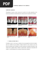 Etapas y Grados de Caries PDF | PDF | Diente | Odontología