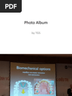 Hybrid Hyrax Distalizer for Class III Treatment | PDF | Orthodontics ...