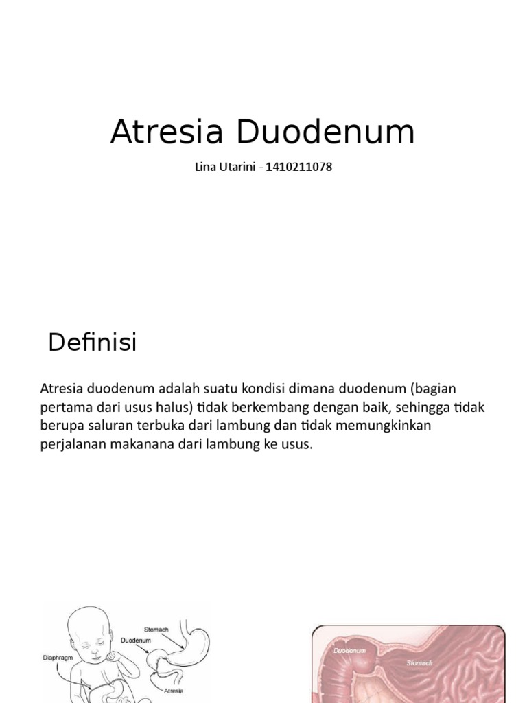 Atresia Duodenum | PDF