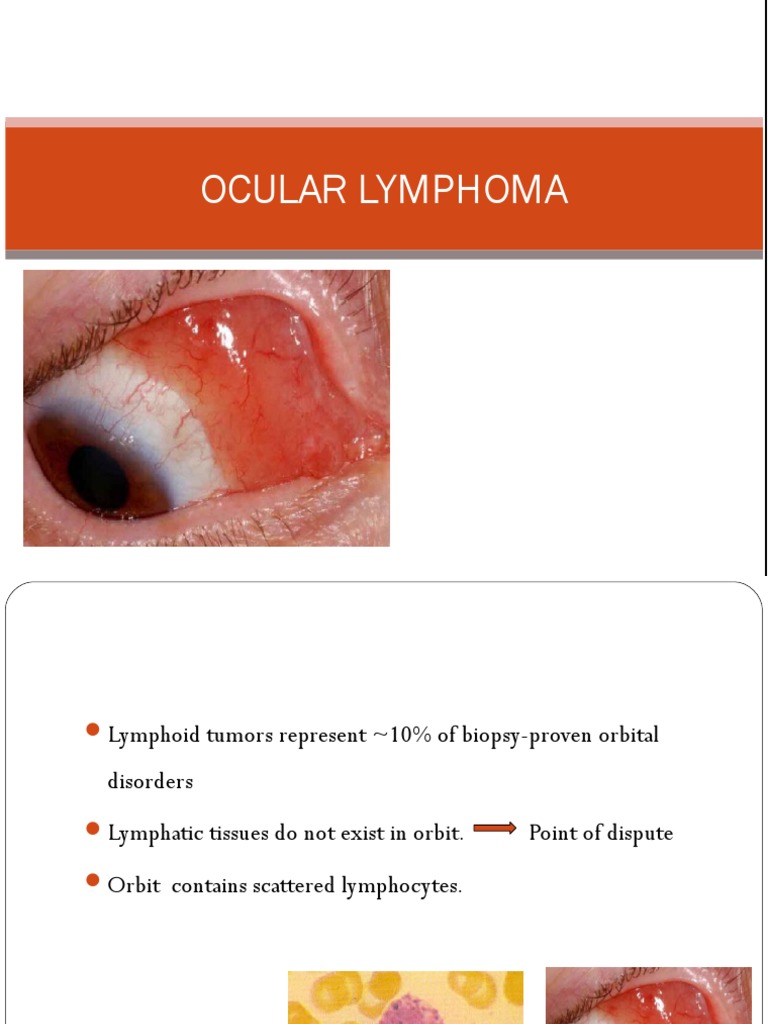Ocular Lymphoma | PDF | Lymphoma | B Cell