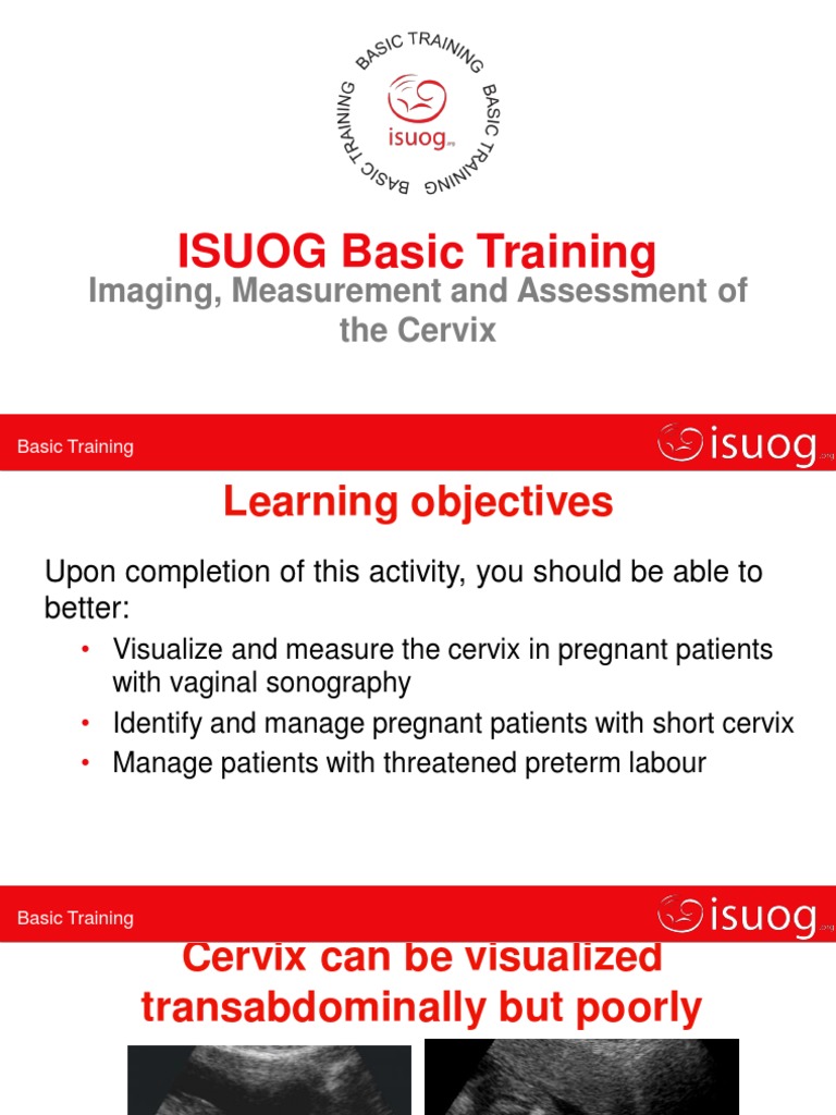 Cervix Isuog | PDF | Preterm Birth | Childbirth