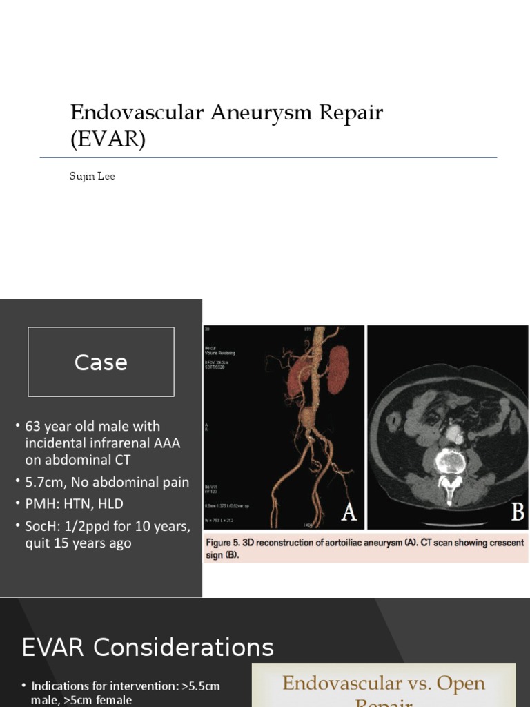 Endovascular Aneurysm Repair (EVAR) : Sujin Lee | PDF