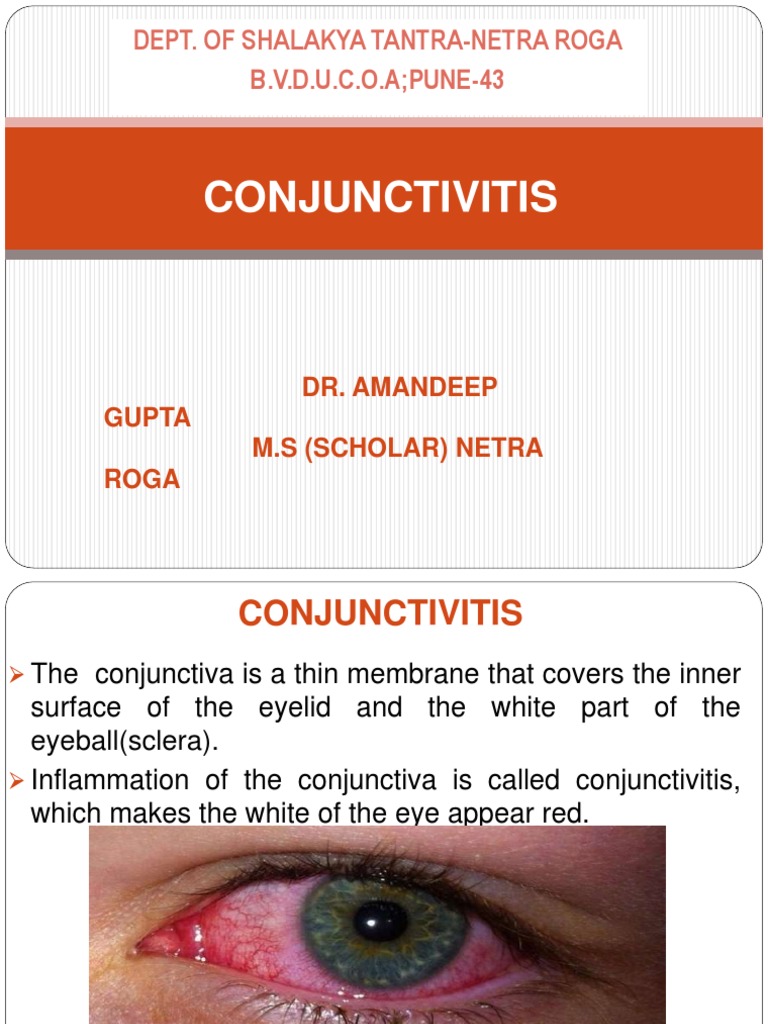 Conjunctivitis | PDF | Epidemiology | Ophthalmology