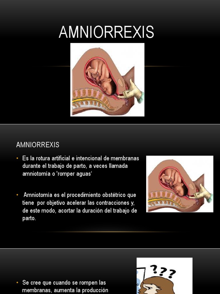 AMNIORREXIS | PDF | Parto | Embarazo humano