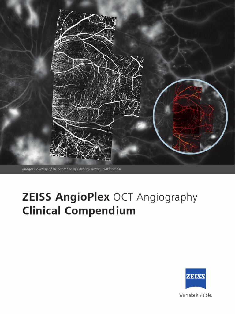ZEISS AngioPlex Clinical Compendium US 31 025 0070I | PDF | Medicine ...